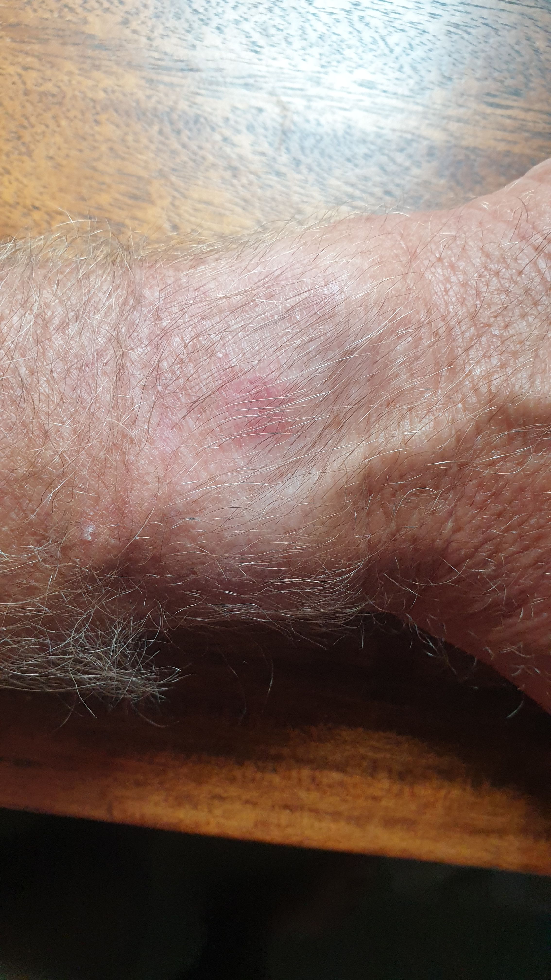 I have a wrist burn from wearing my Galaxy Watch 4 - Samsung Community