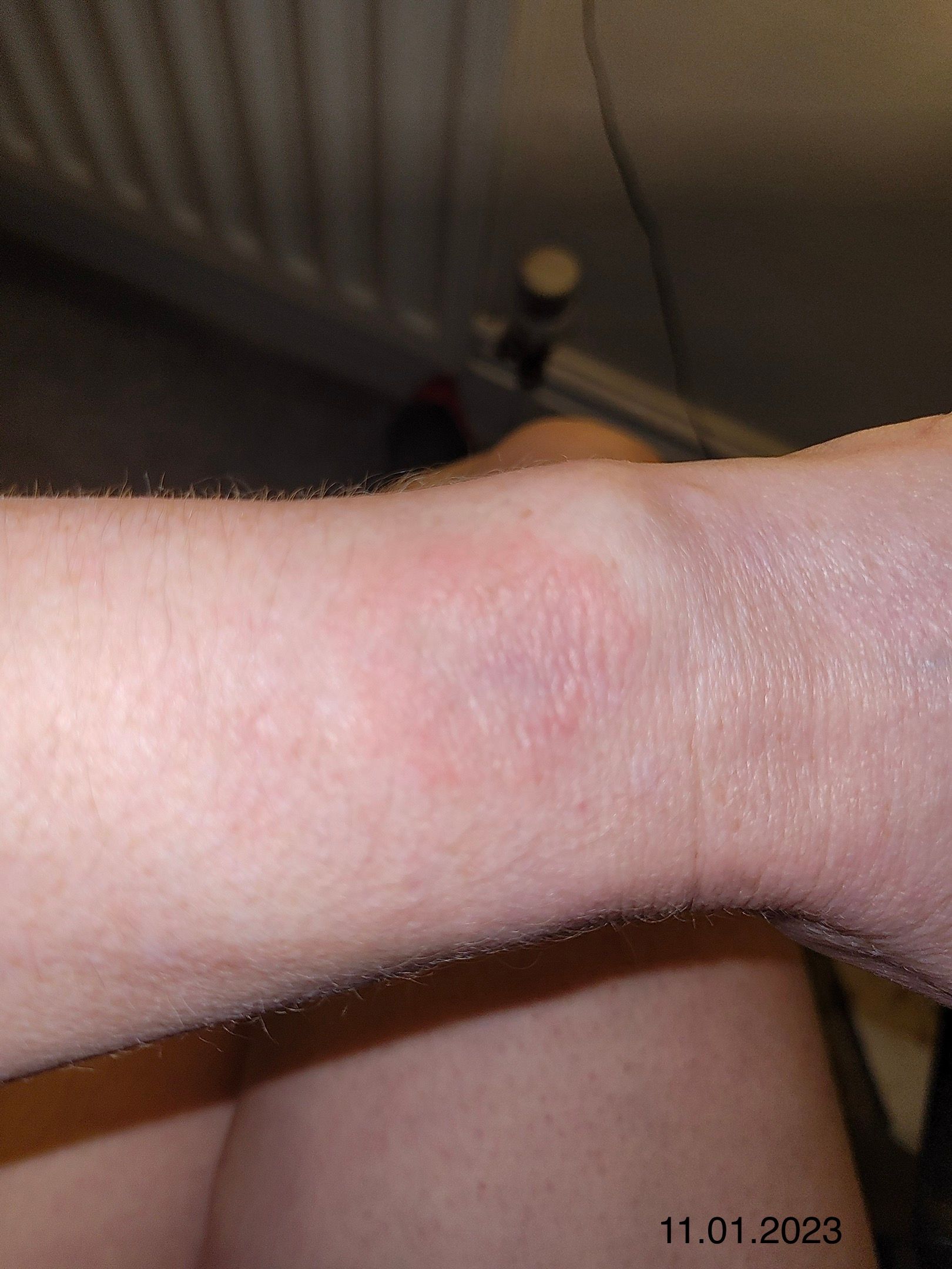 Galaxy 4 Watch Wrist Burn - Samsung Community