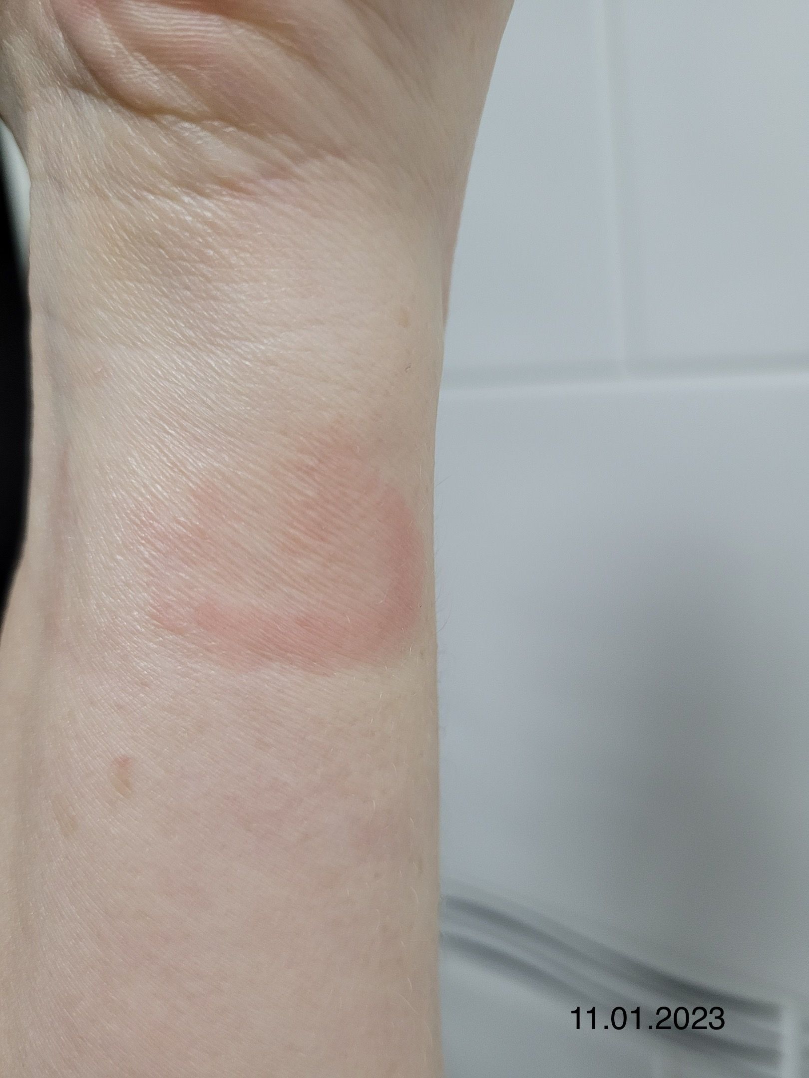 Galaxy 4 Watch Wrist Burn - Samsung Community