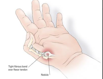 Fold/Flip - Trigger Thumb - Samsung Community