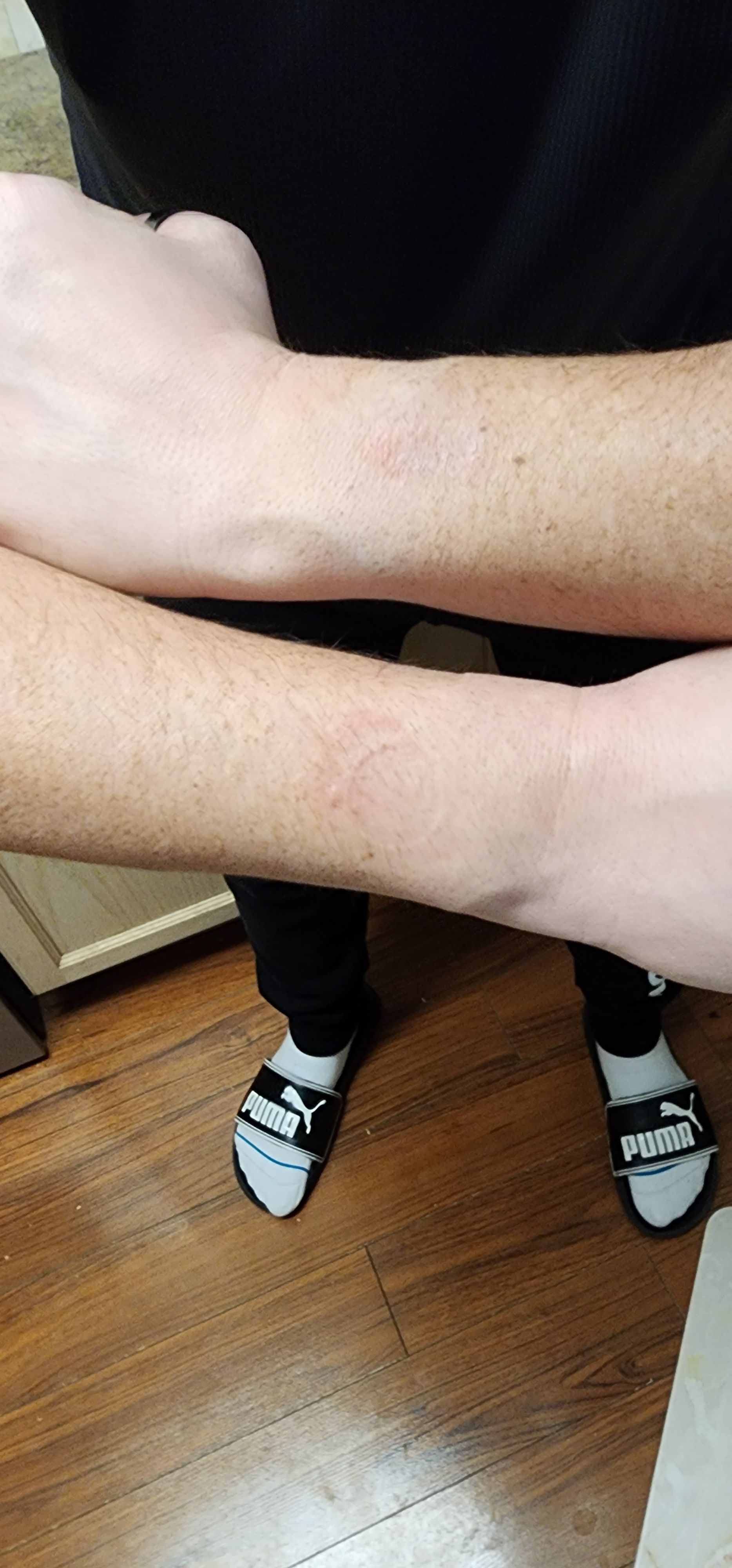 Rash from Galaxy Watch Active - Samsung Community