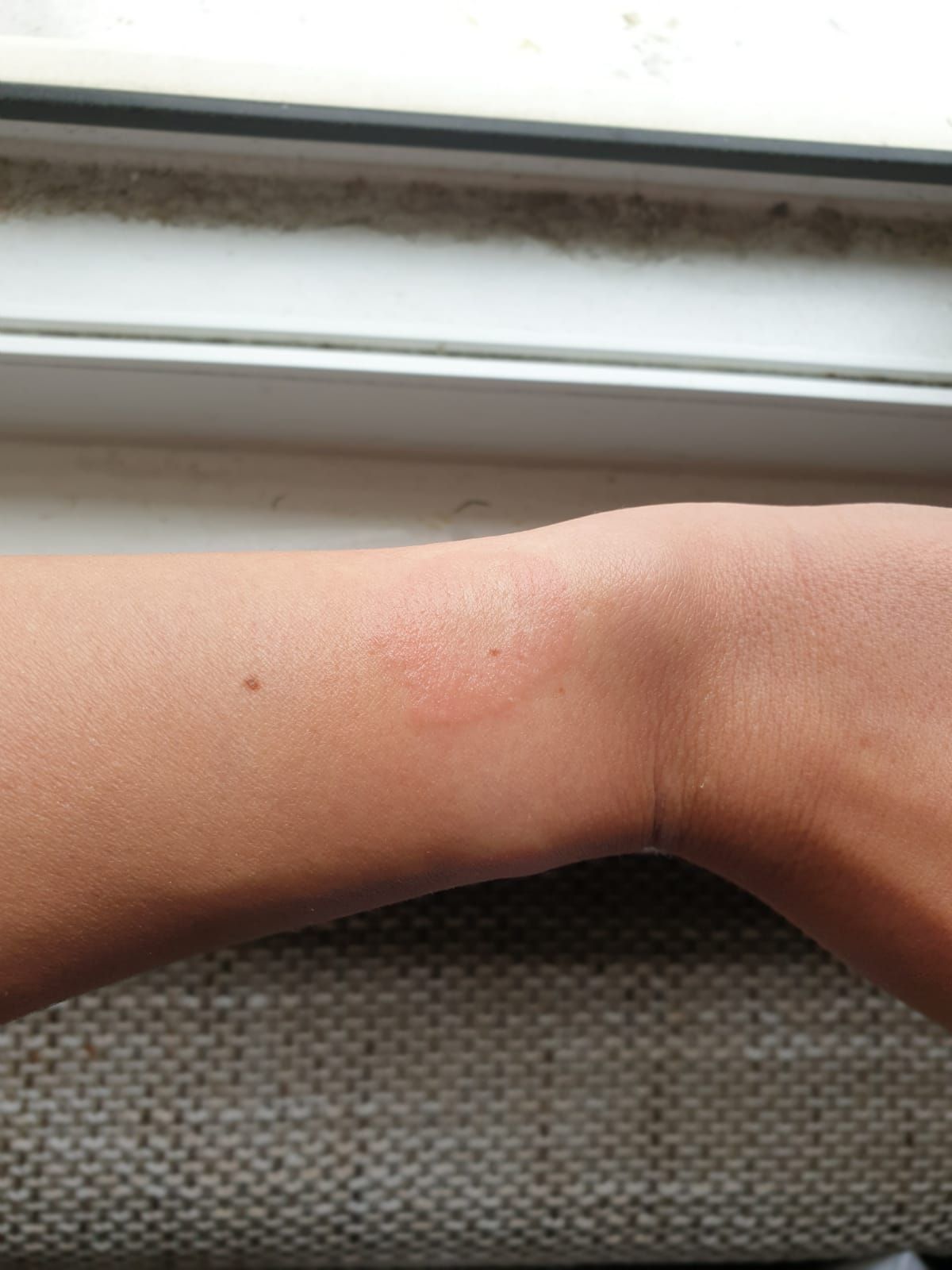 Galaxy Active Watch red burn or rash - Samsung Community