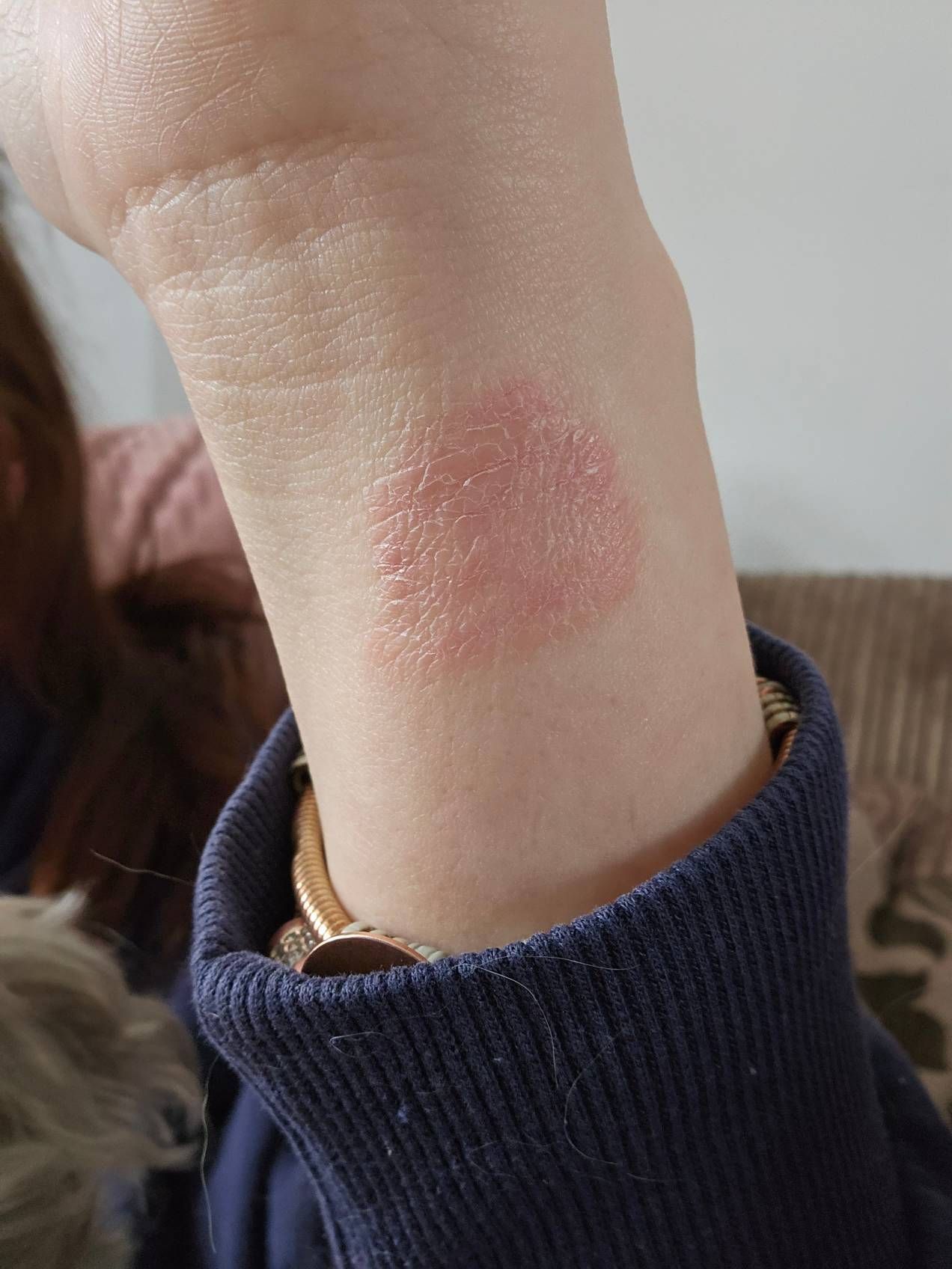 Solved: Galaxy 4 Wrist Burn - Samsung Community