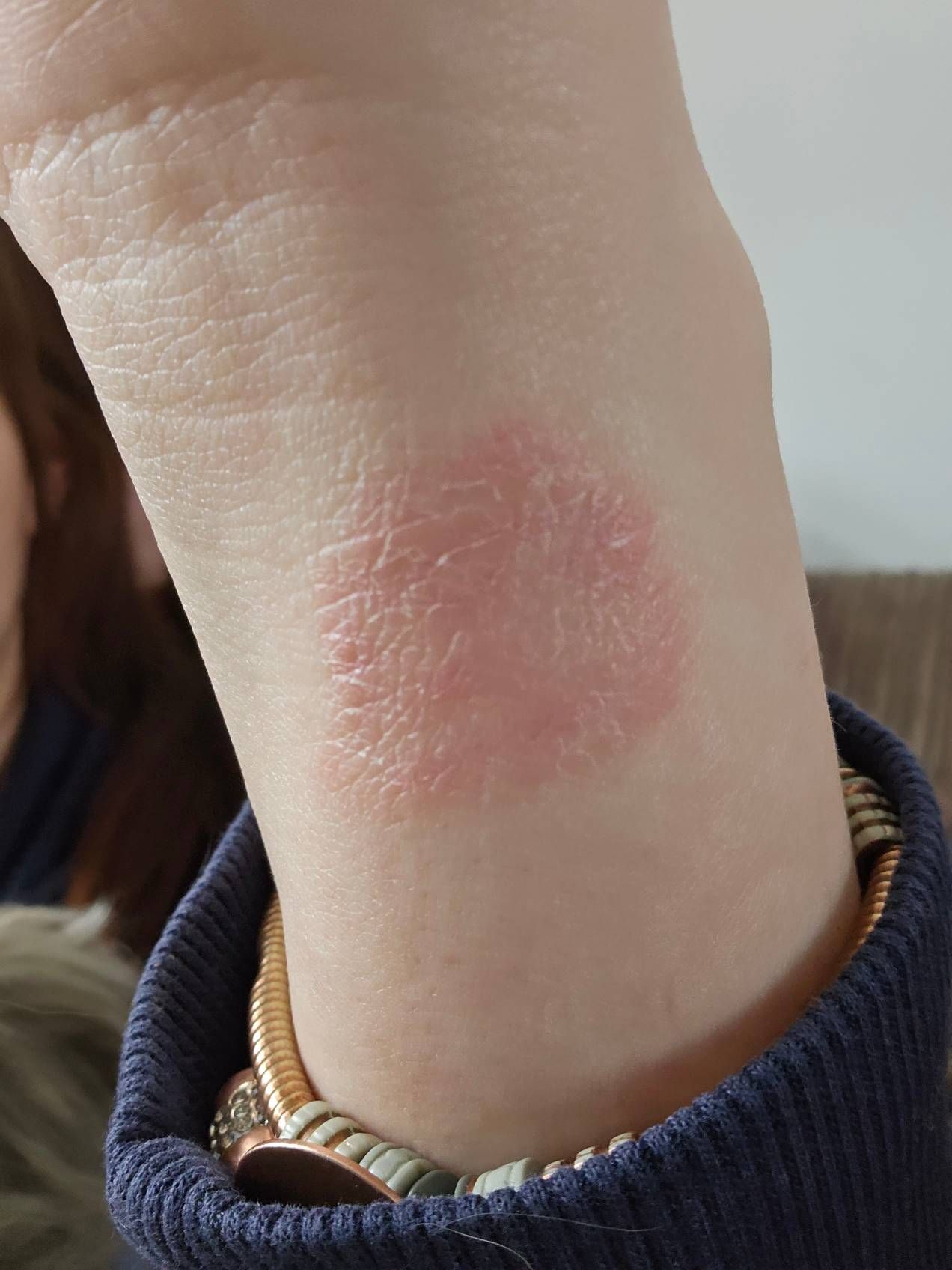 Solved: Galaxy 4 Wrist Burn - Samsung Community