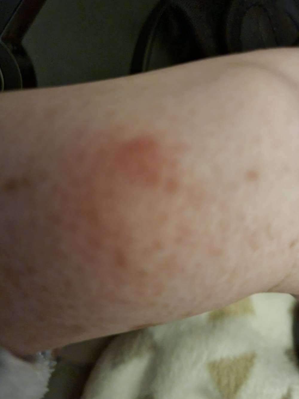 Galaxy Watch4 Classic burning my wrist - Samsung Community