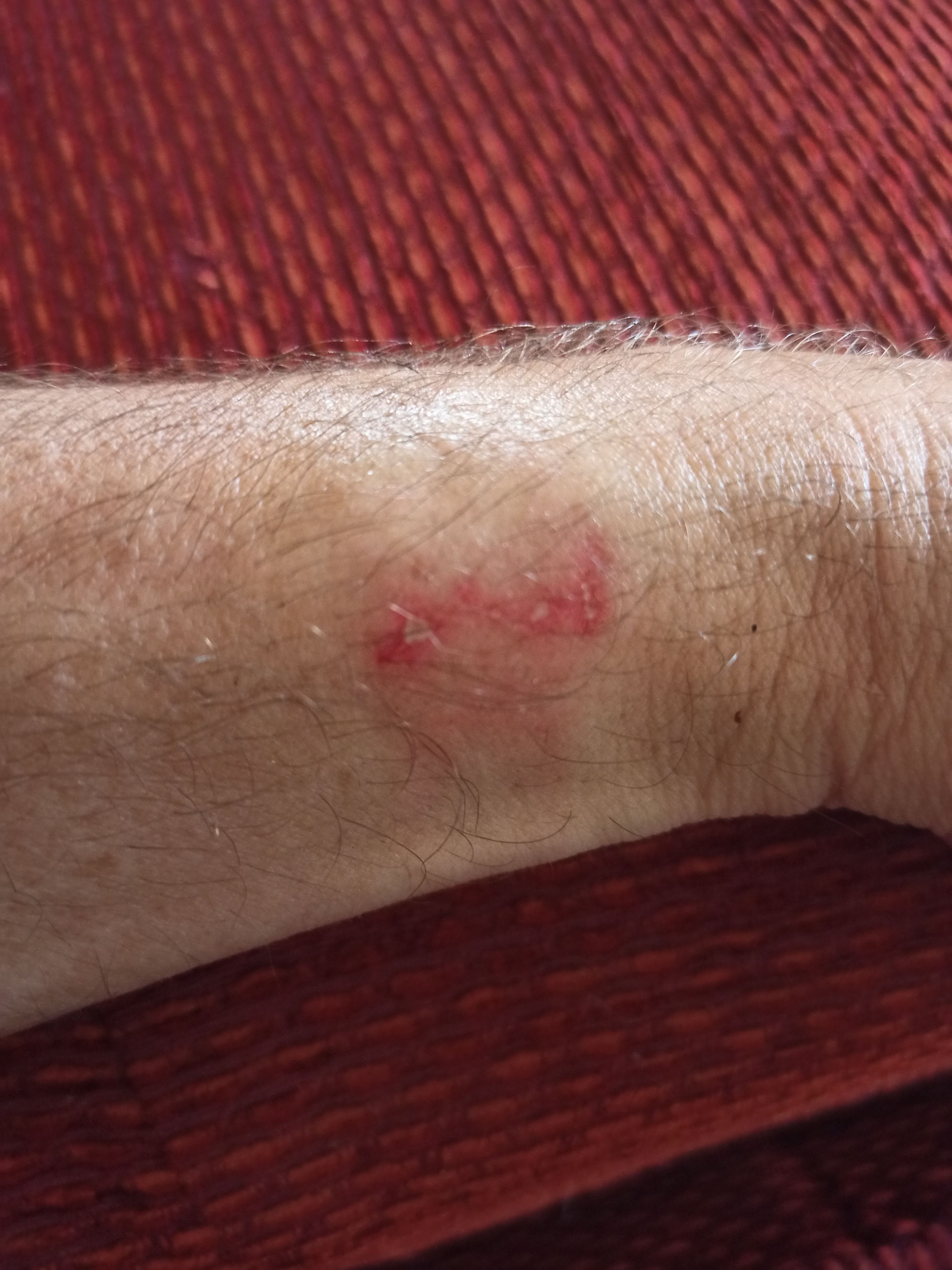 Galaxy Silicon Watchstrap Rash... - Samsung Community