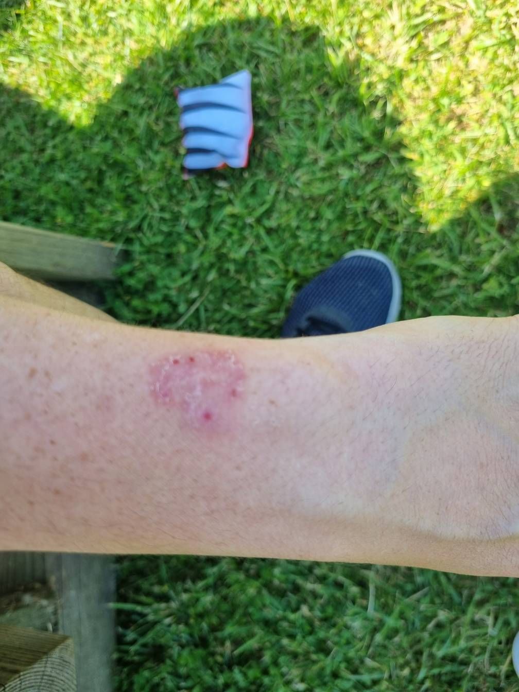 Burns from galaxy watch 5 - Samsung Community