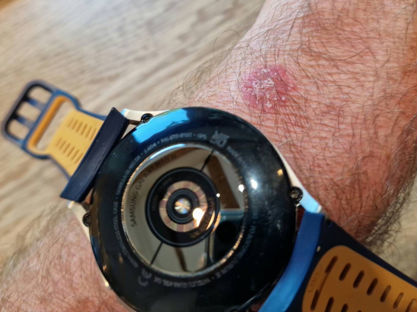 Welt on skin under Watch4 - Samsung Community