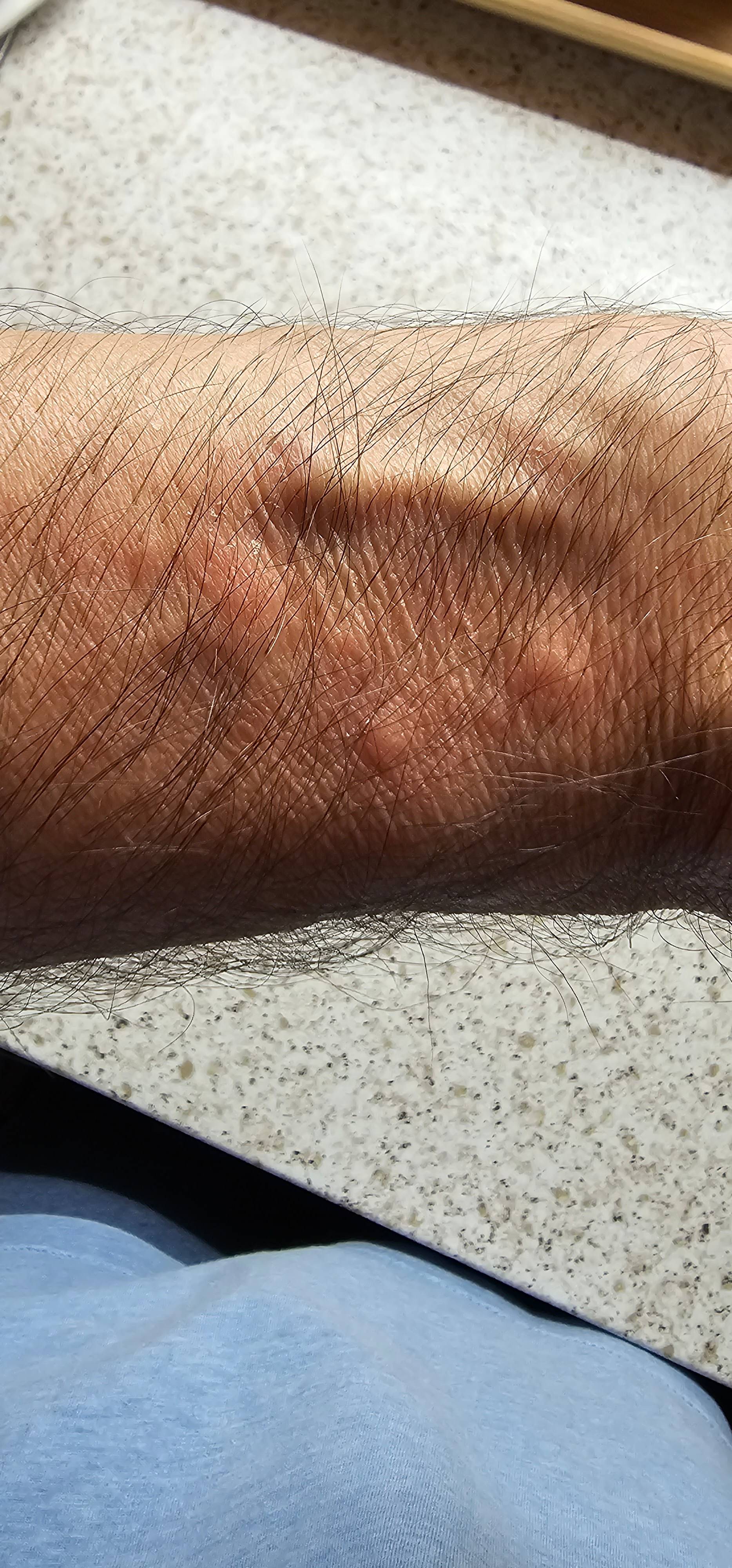 Burn mark on wrist - Page 2 - Samsung Community