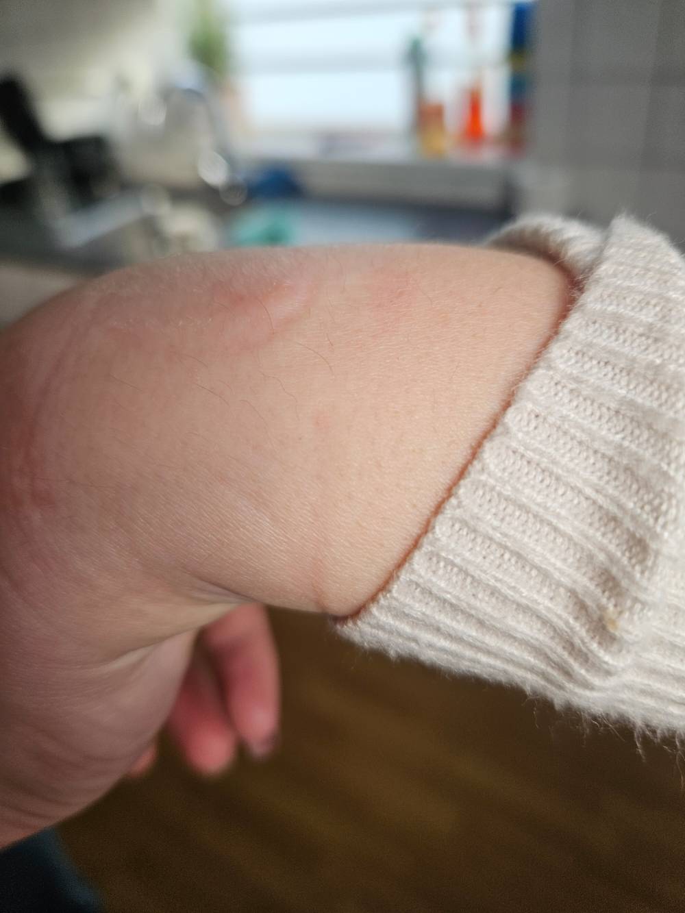 Opgelost: Brandblaar op de pols onder Galaxy watch - Samsung Community