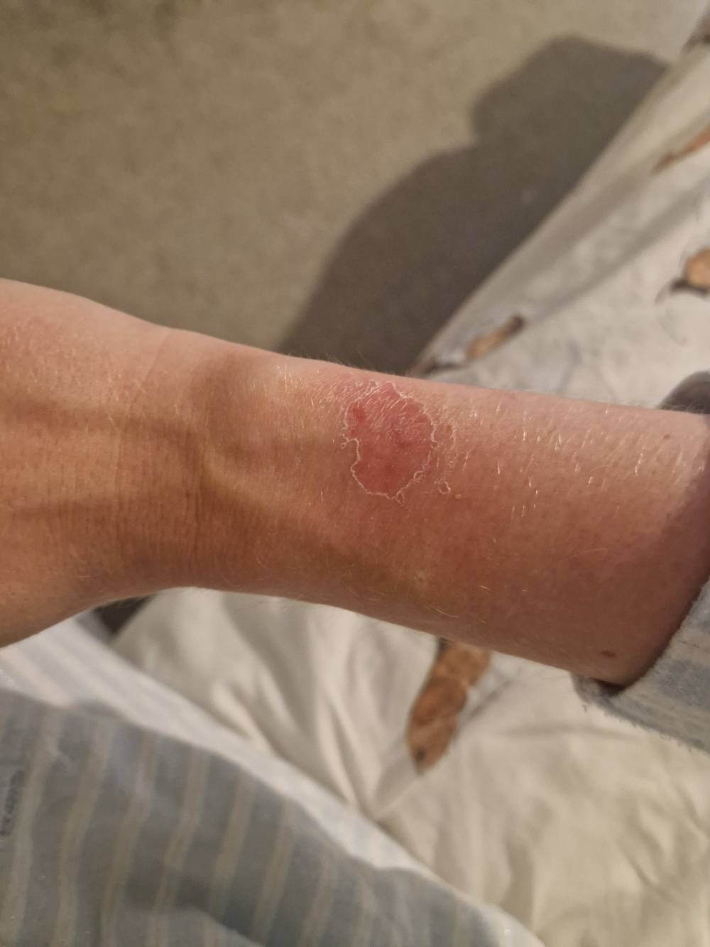 Burns from galaxy watch 5 - Samsung Community