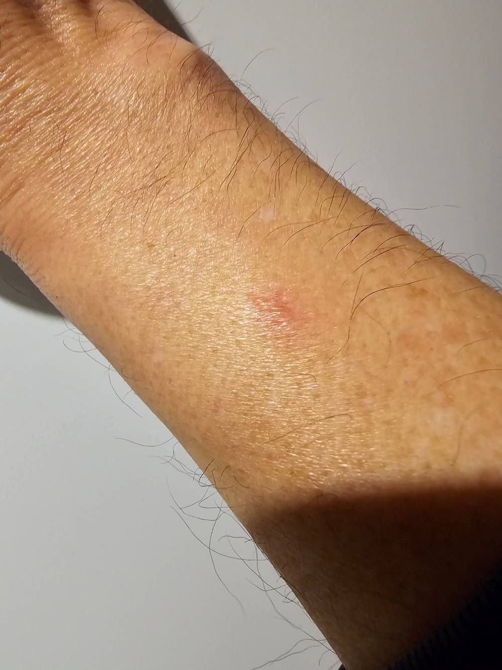 Galaxy Watch 7 burns arm. - Samsung Community