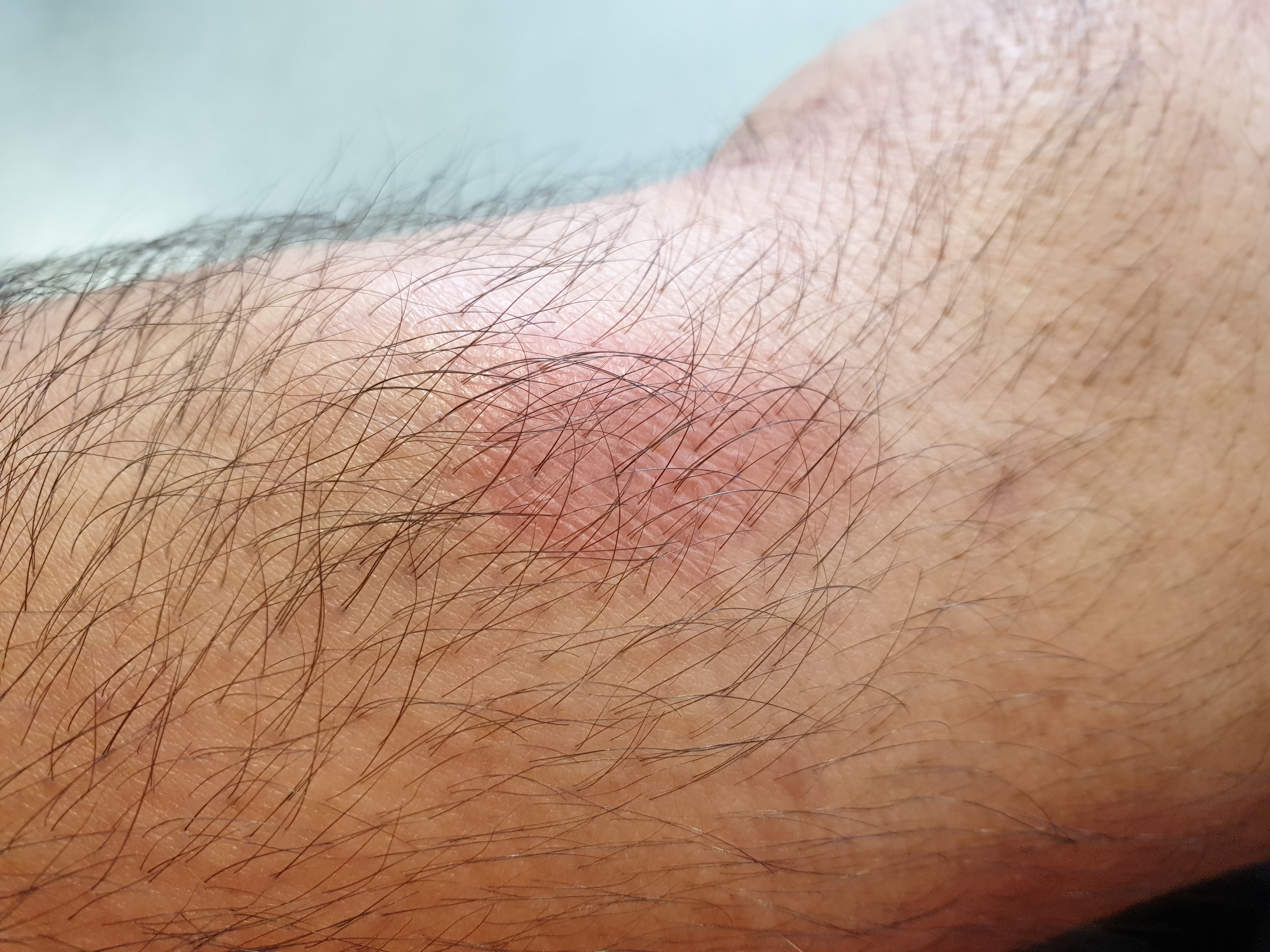 Galaxy watch rash - Page 40 - Samsung Community