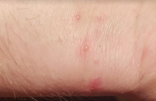 Galaxy watch rash - Page 36 - Samsung Community