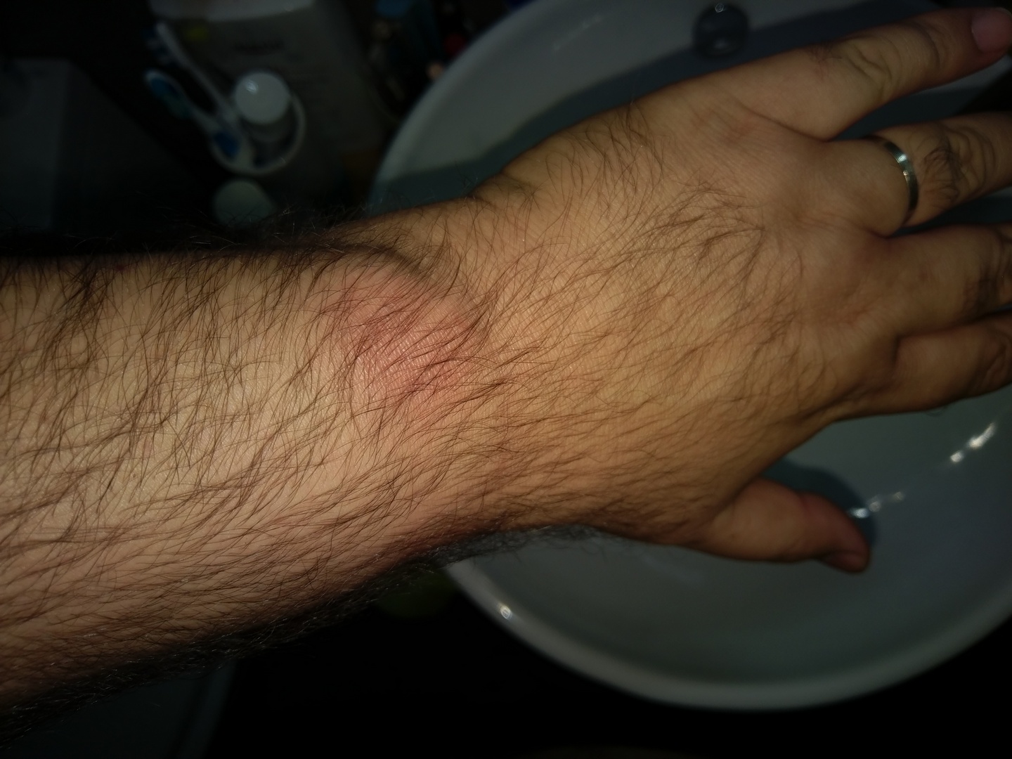 Galaxy watch rash - Samsung Community