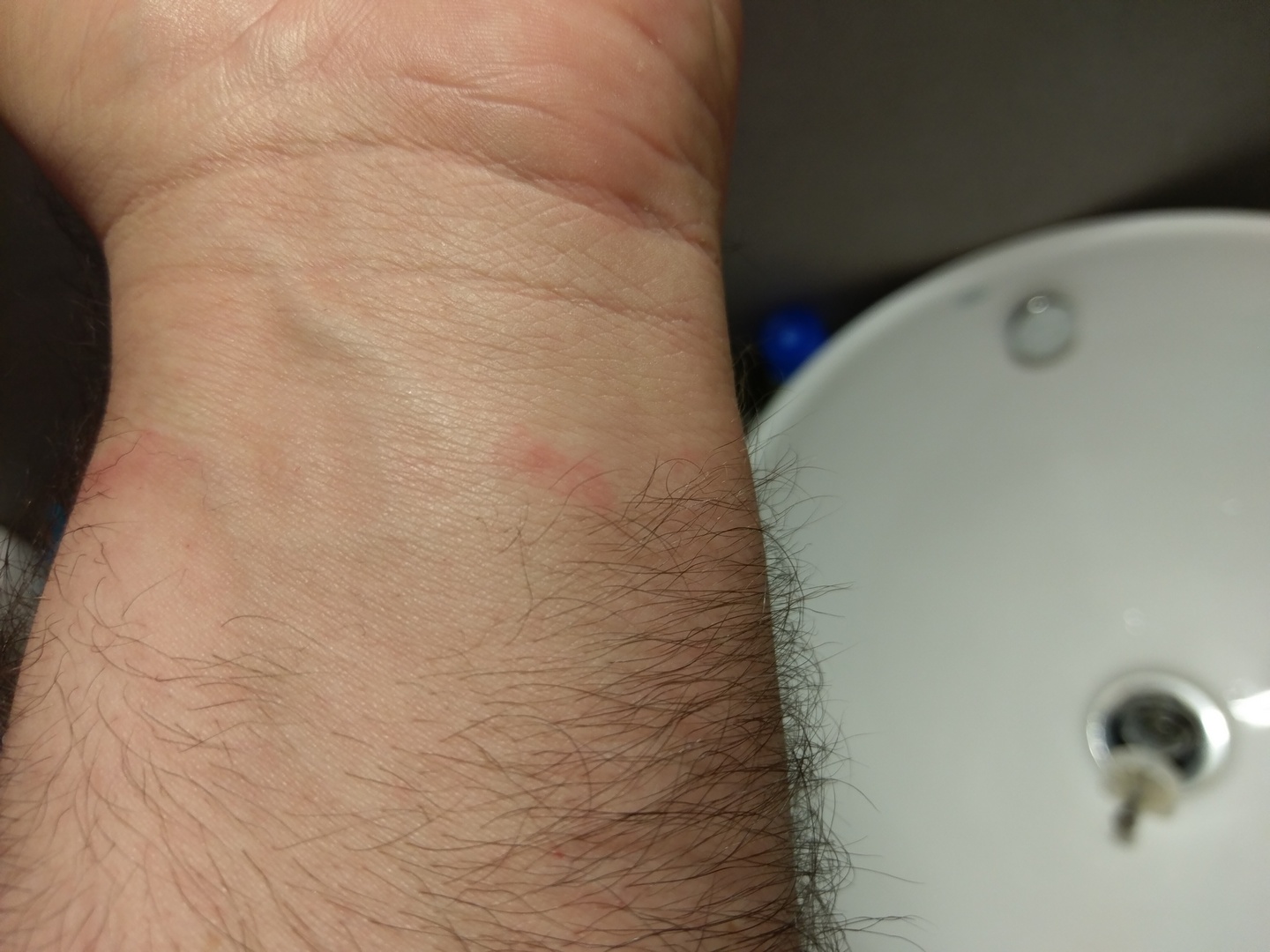 Galaxy watch rash - Page 36 - Samsung Community