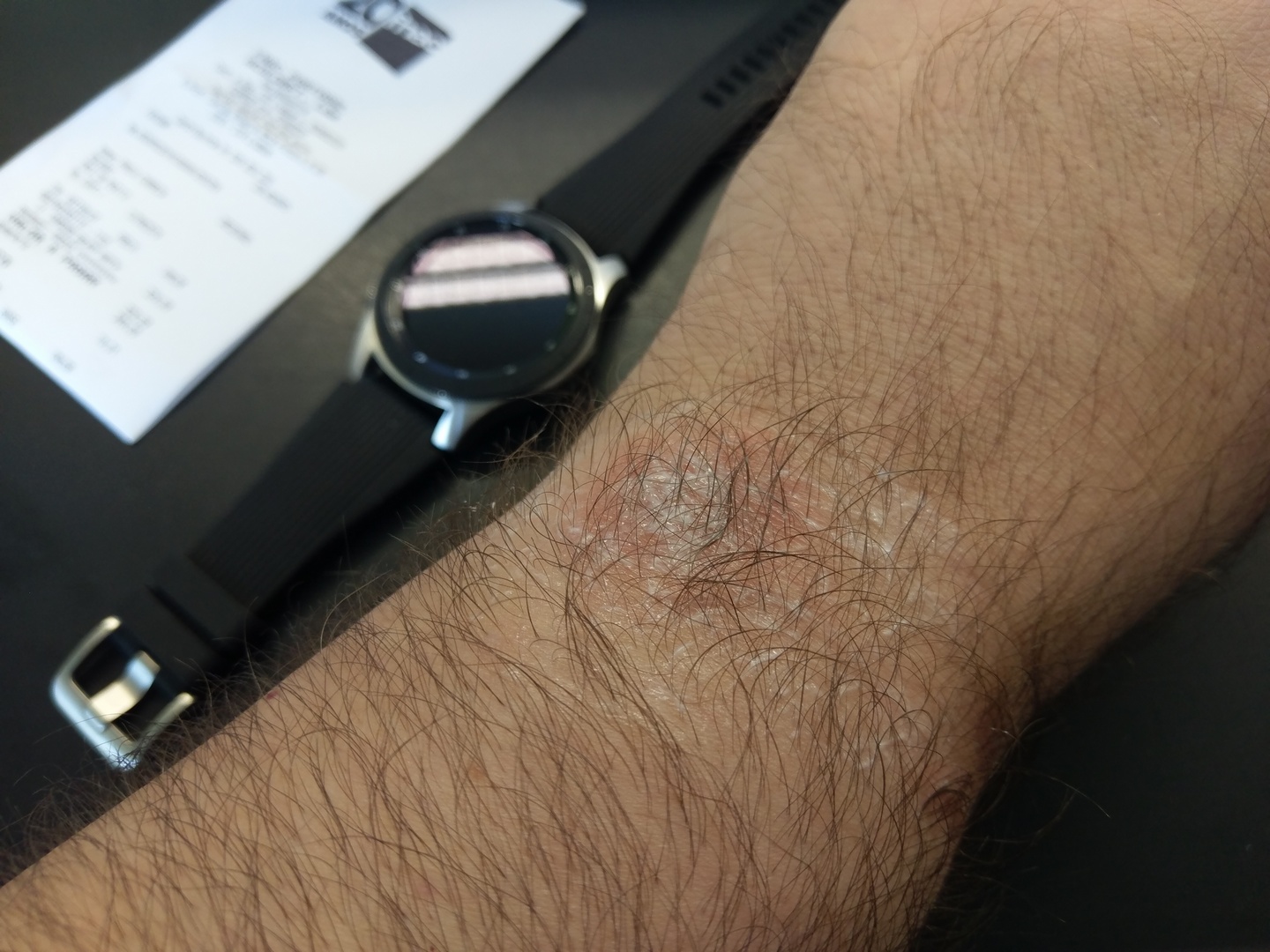 Galaxy watch rash - Samsung Community