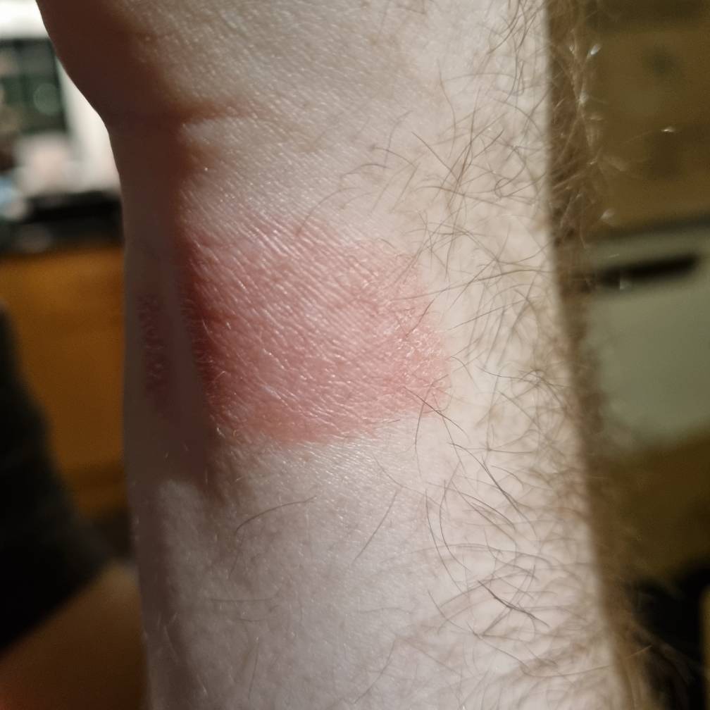 RASH with Samsung Galaxy Watch Active 2 - Samsung Community