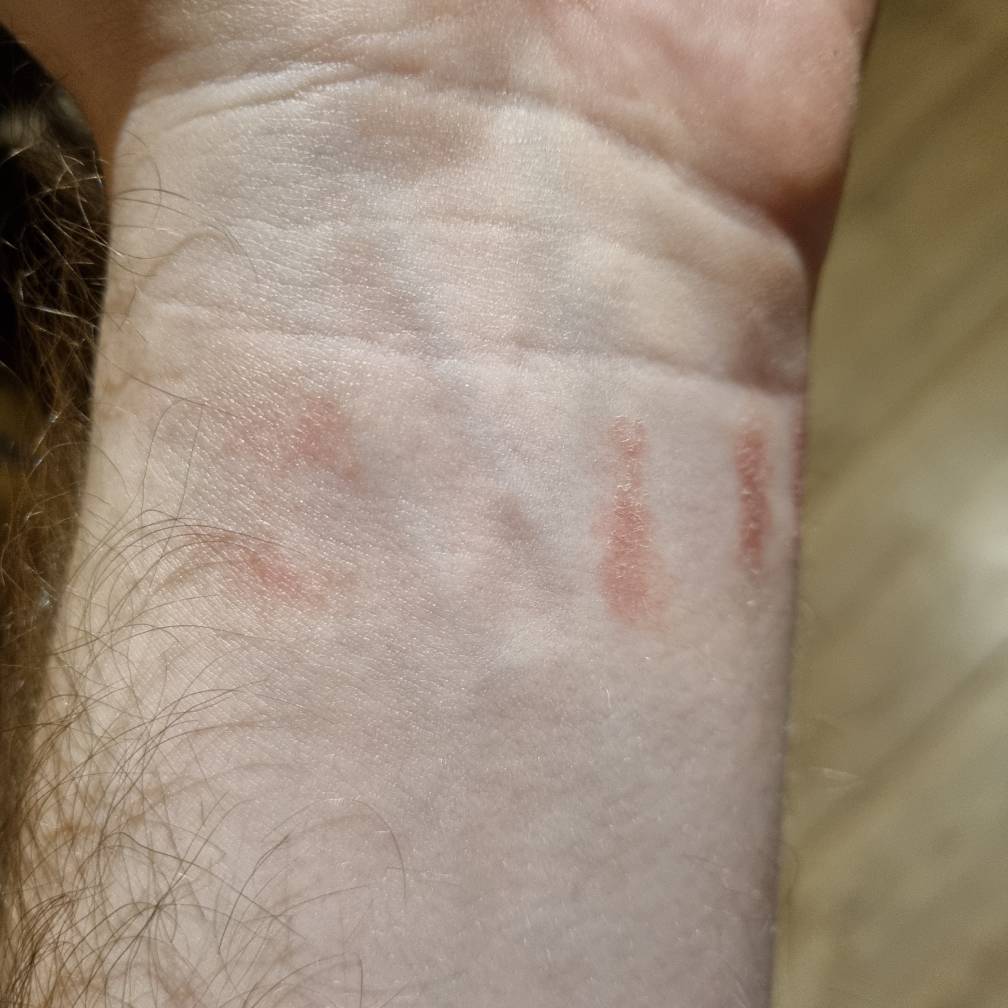 RASH with Samsung Galaxy Watch Active 2 - Samsung Community