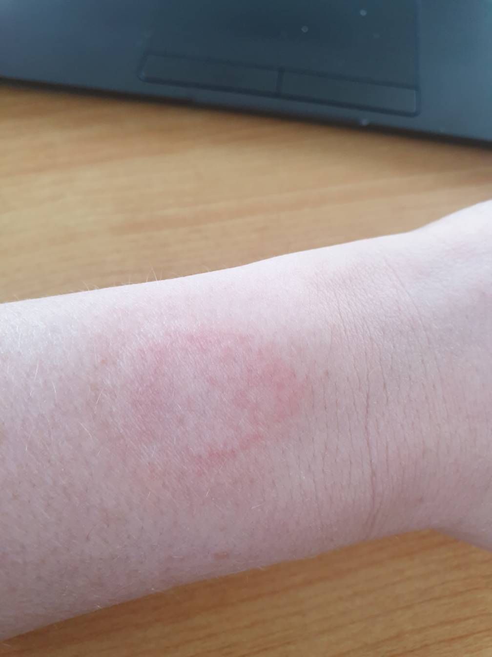 Skin rash/burn from wearing samsung watch - Samsung Community