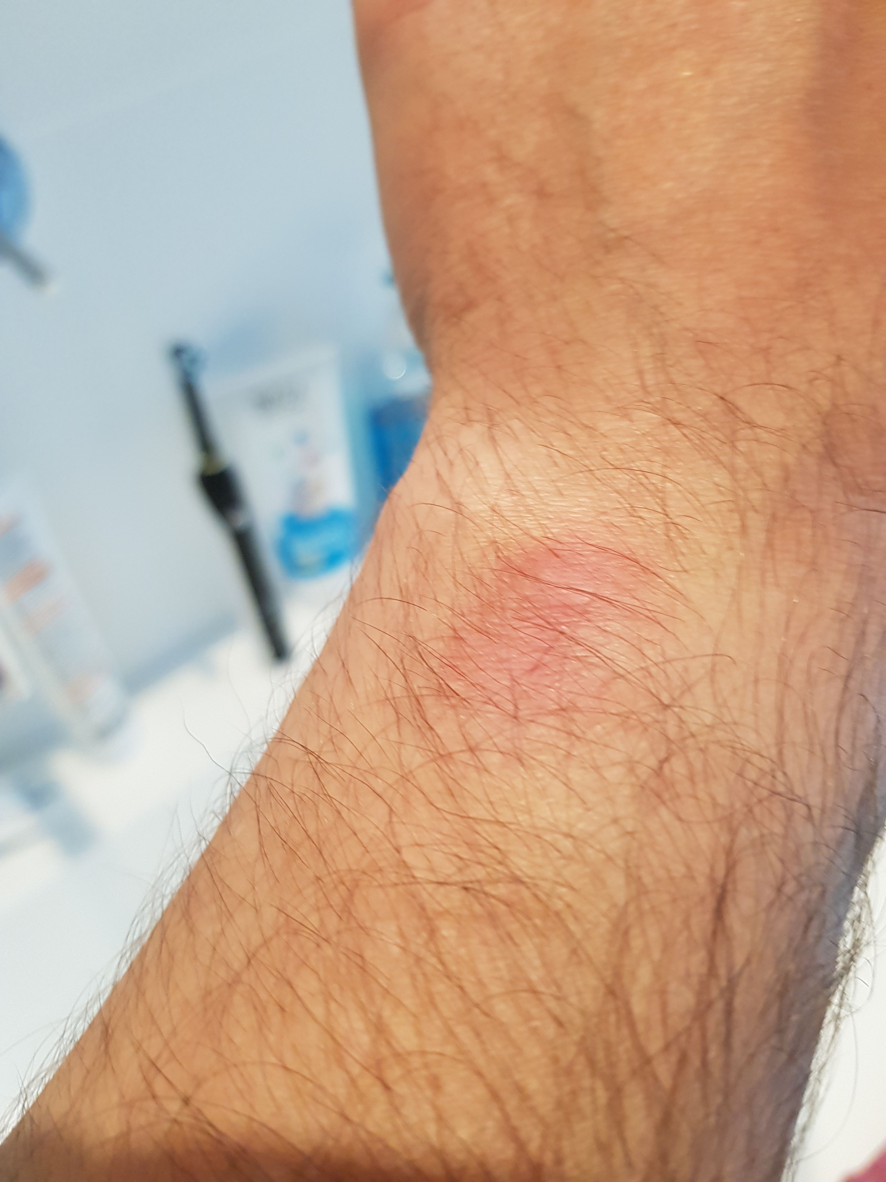 Skin rash/burn from wearing samsung watch - Samsung Community