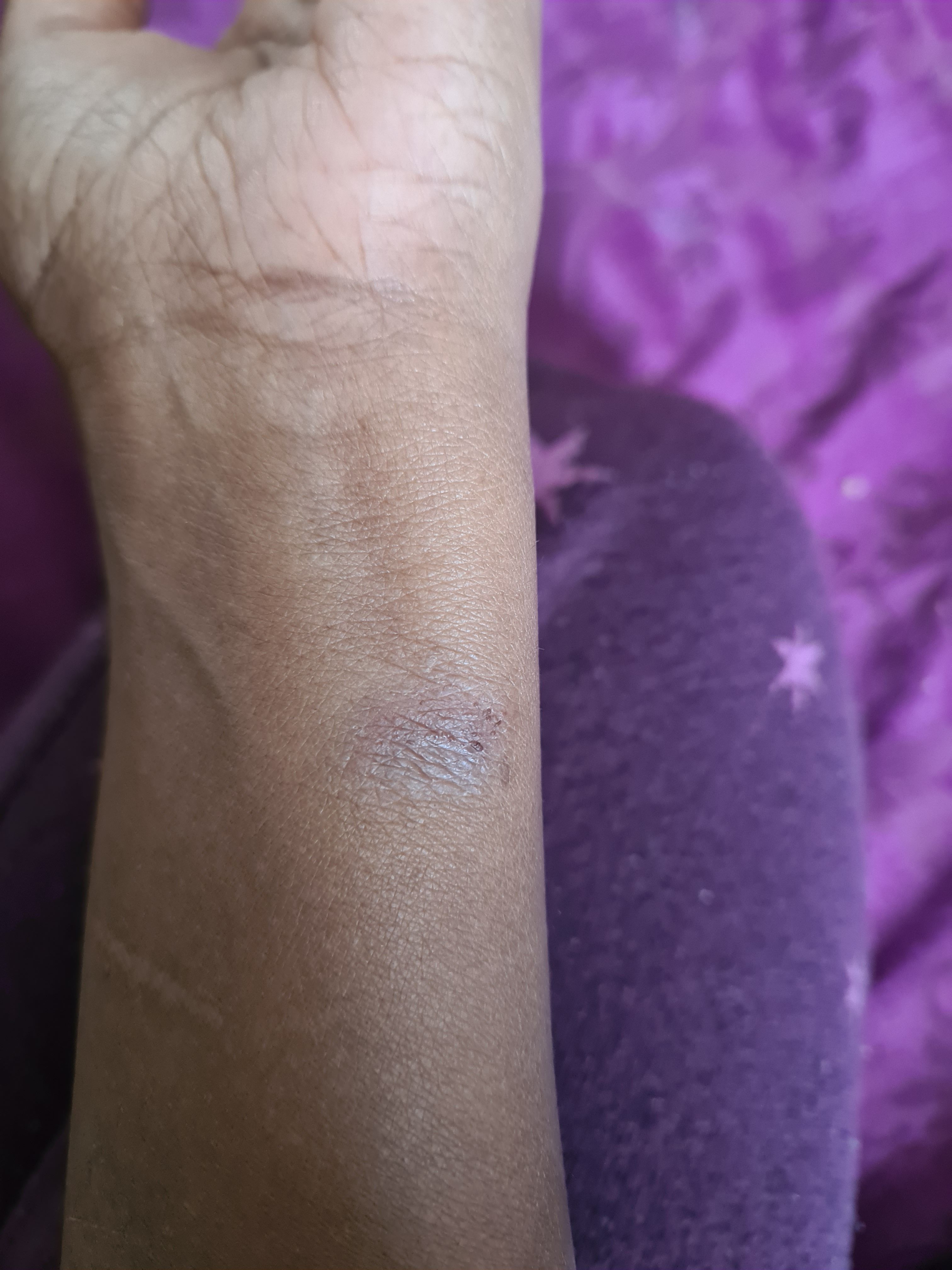 Active watch 2 rash - Samsung Community