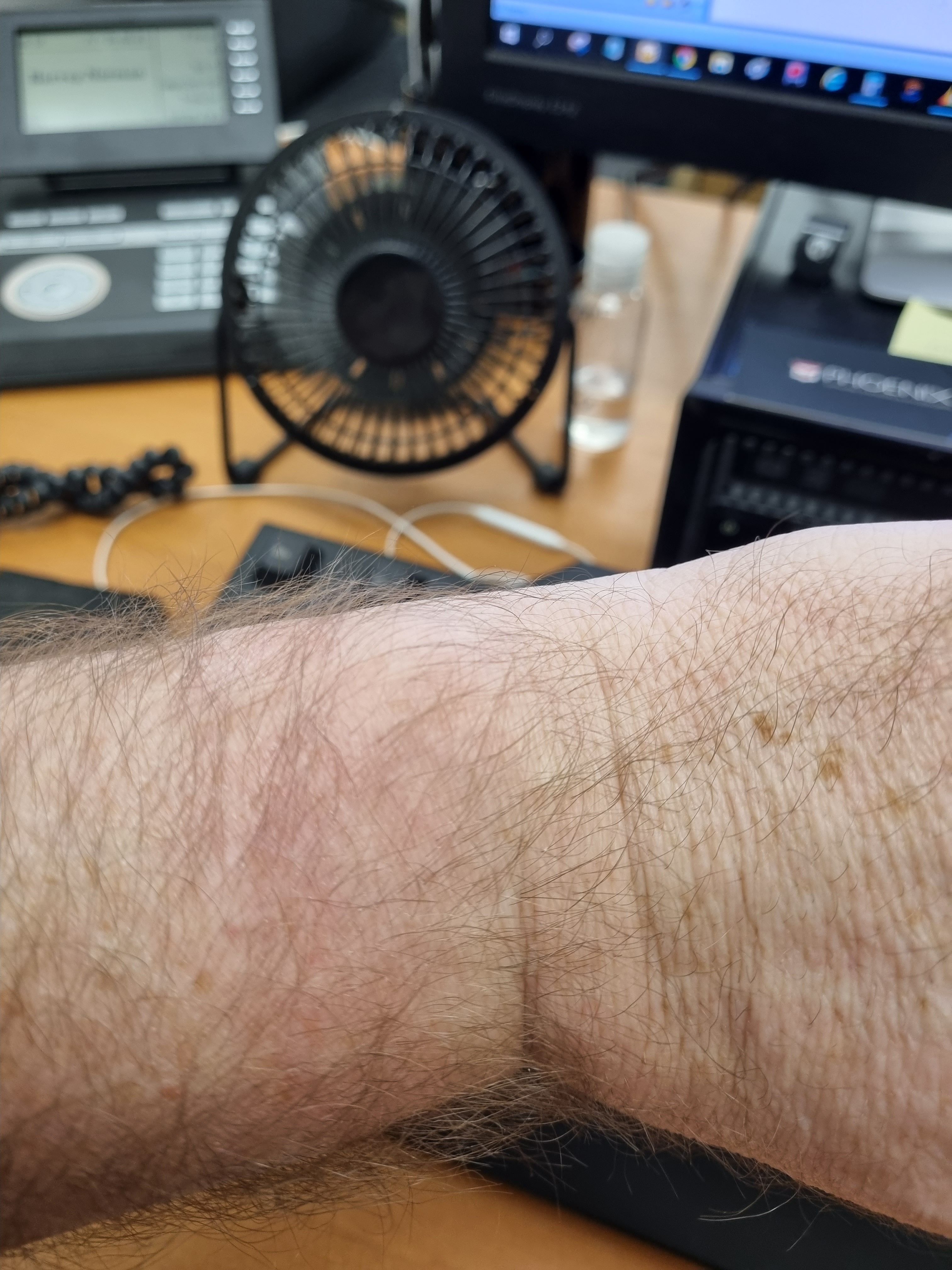 Re: Galaxy watch rash - Page 47 - Samsung Community