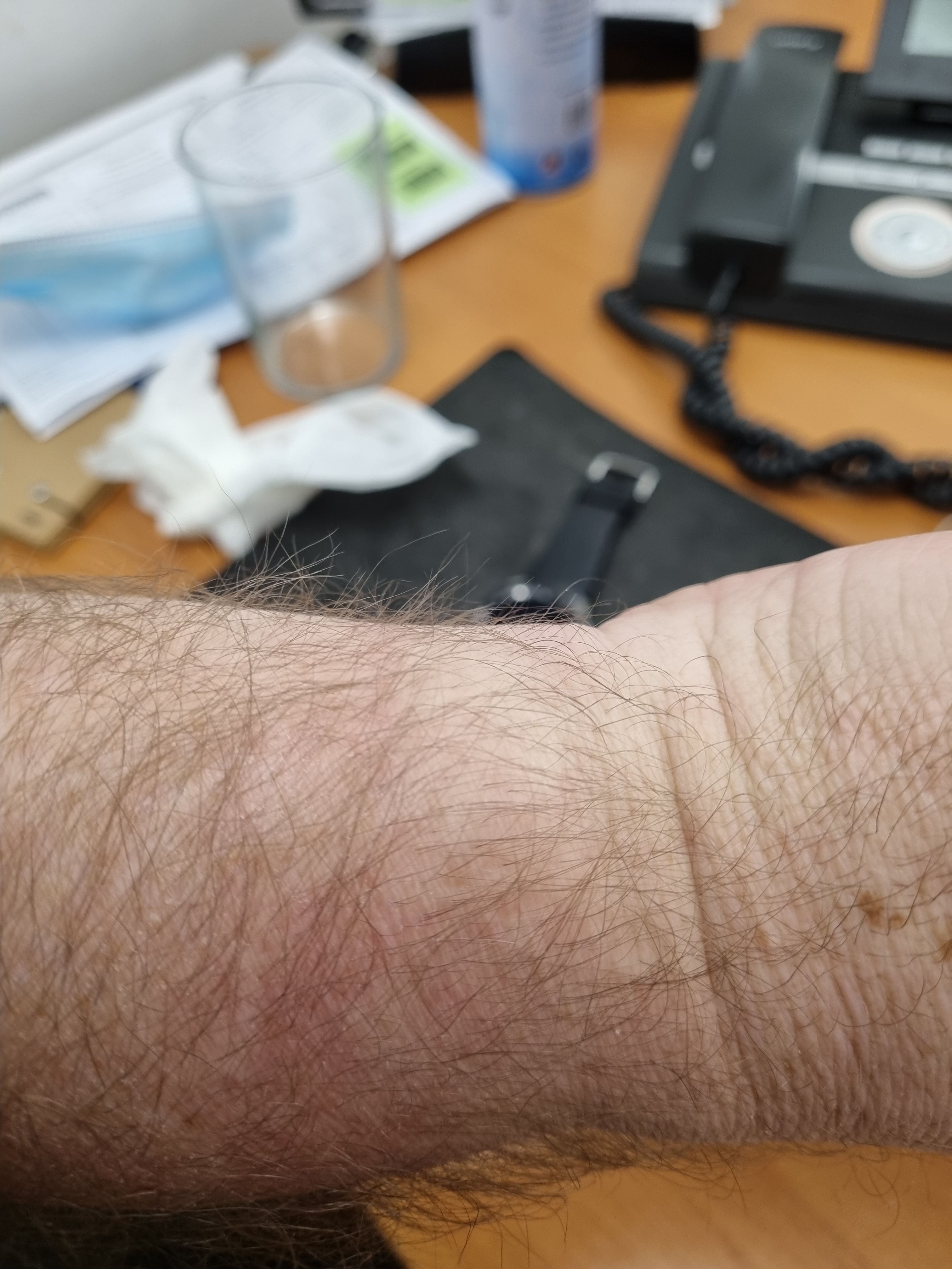 Re: Galaxy watch rash - Page 47 - Samsung Community