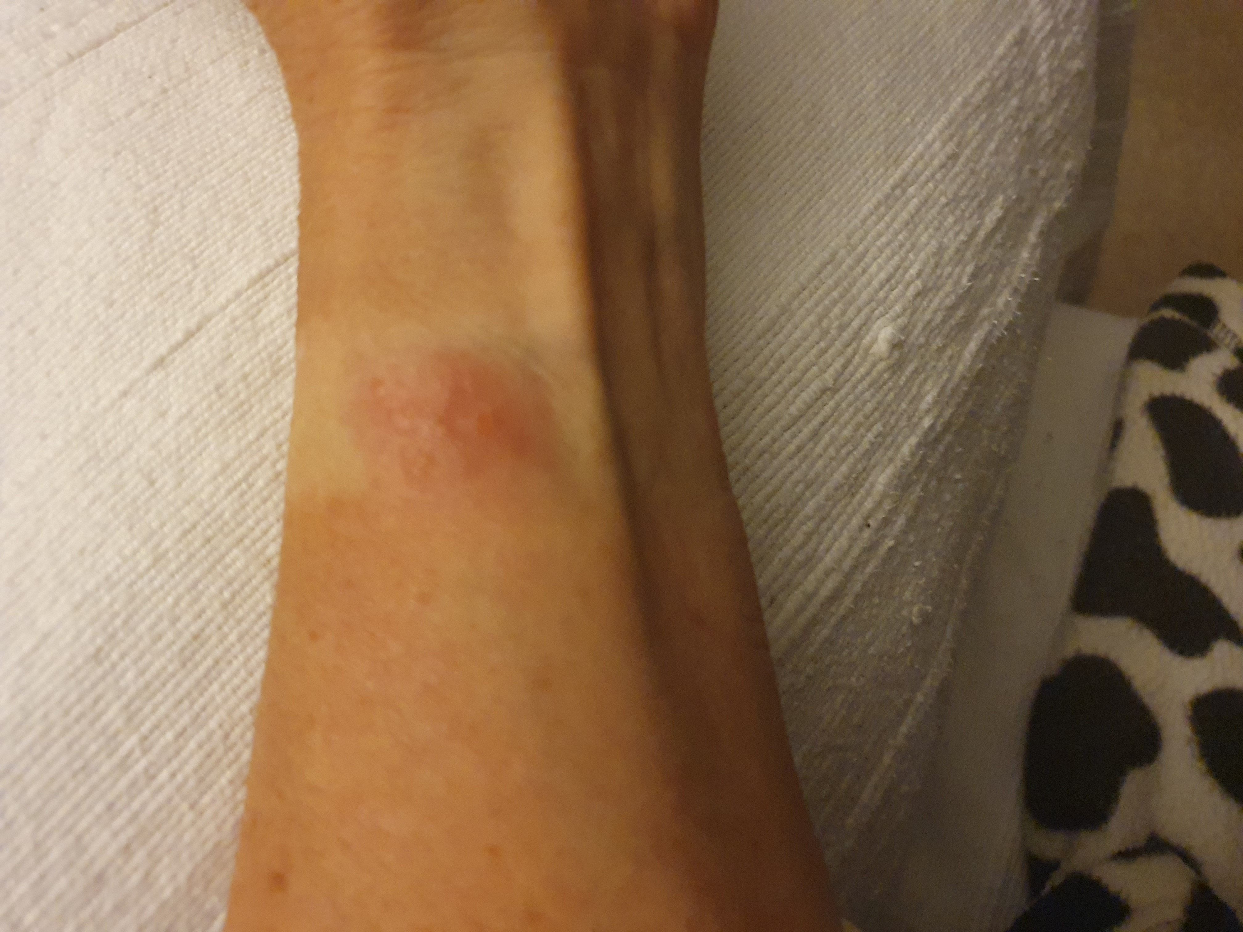 Active watch 2 rash - Samsung Community