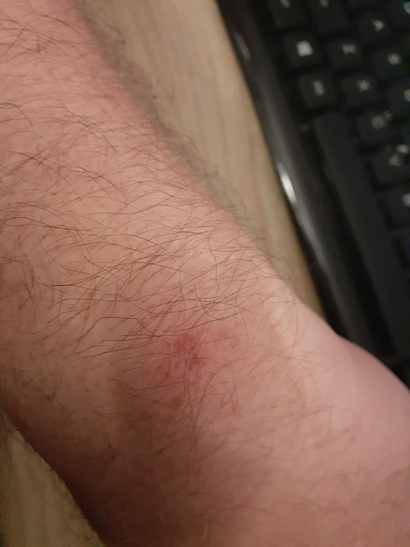 Samsung Watch 4 Classic Burning My Wrist - Page 4 - Samsung Community