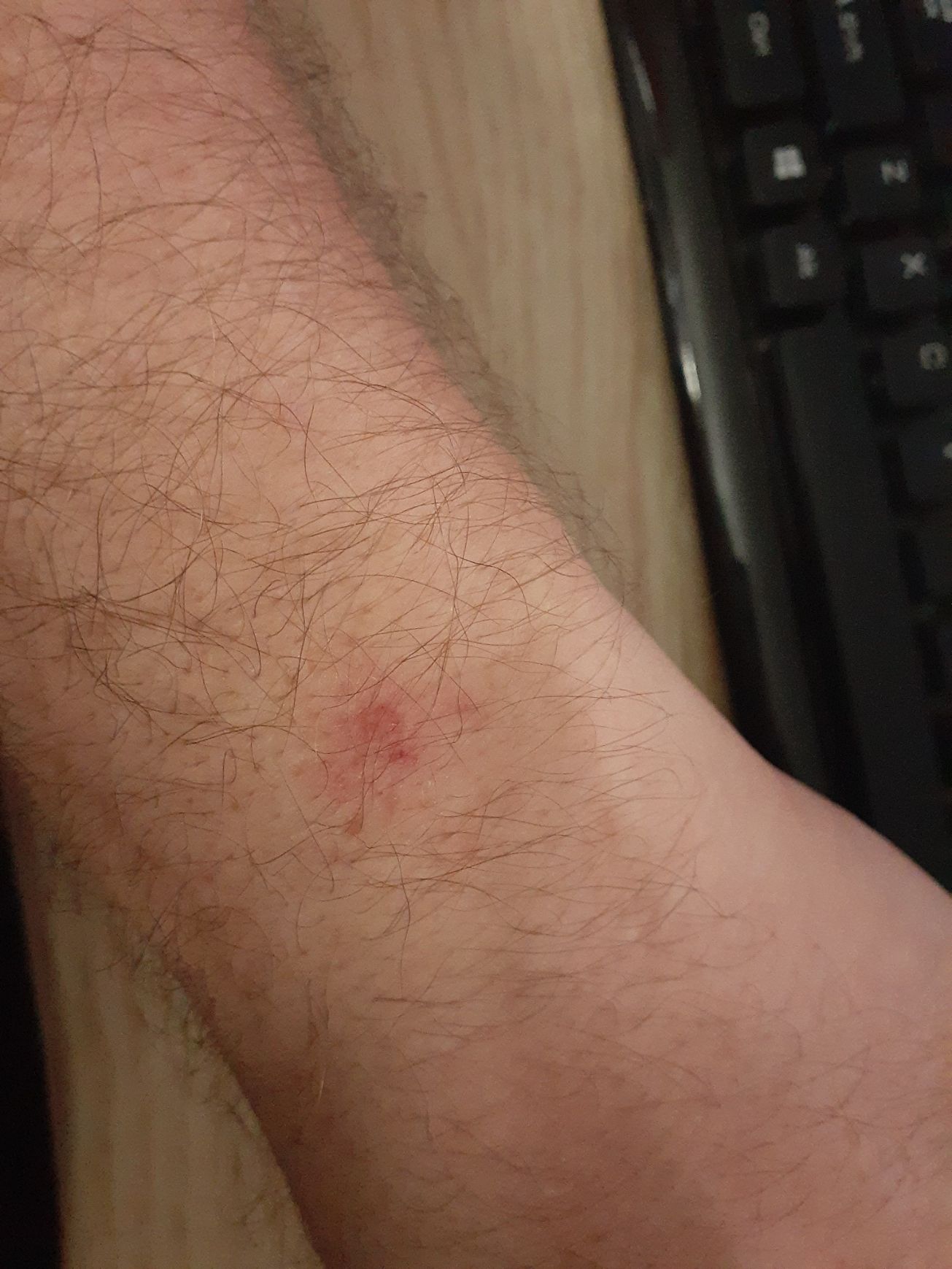 Samsung Watch 4 Classic Burning My Wrist - Samsung Community