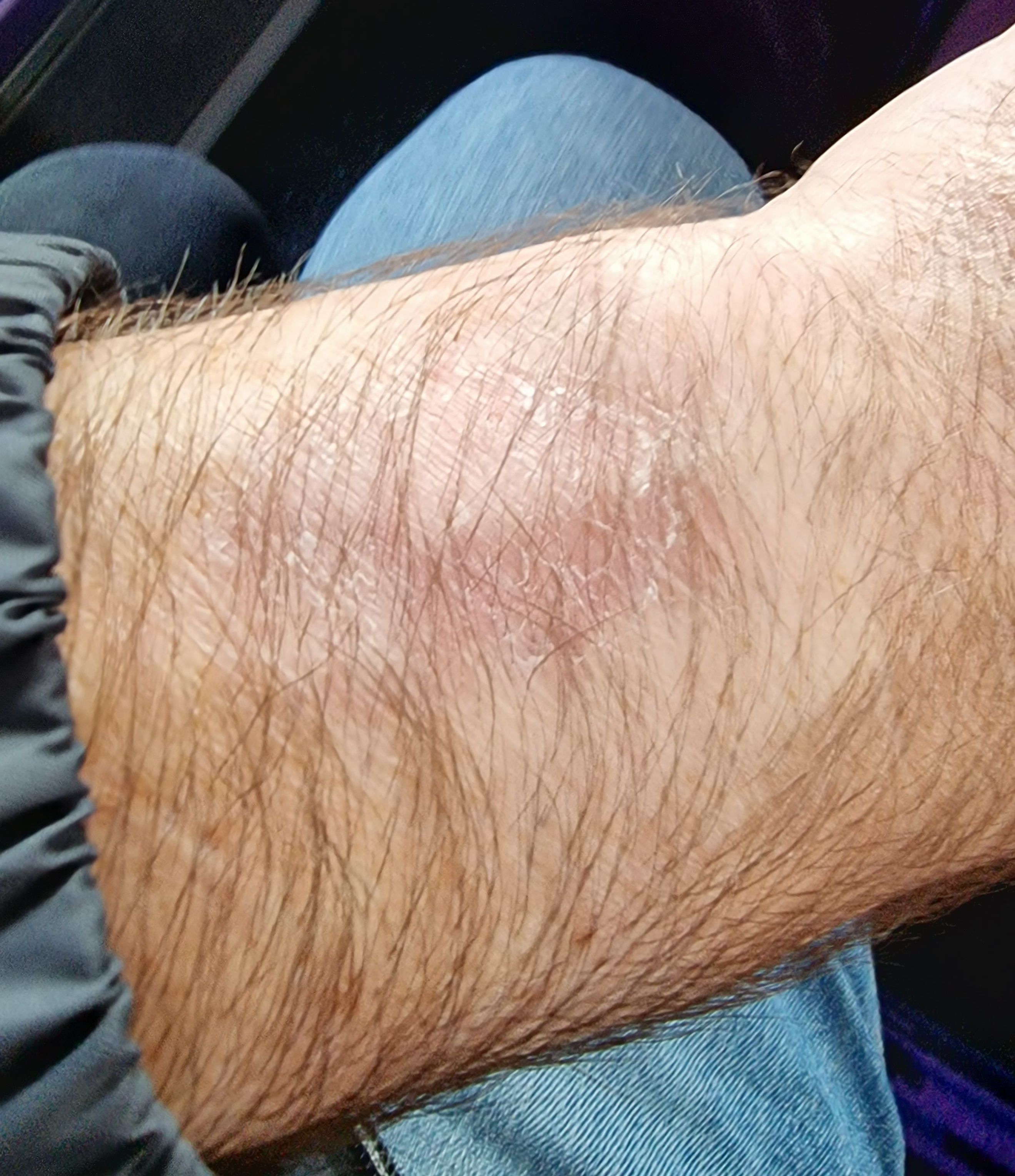 Samsung Watch 4 Classic Burning My Wrist - Samsung Community