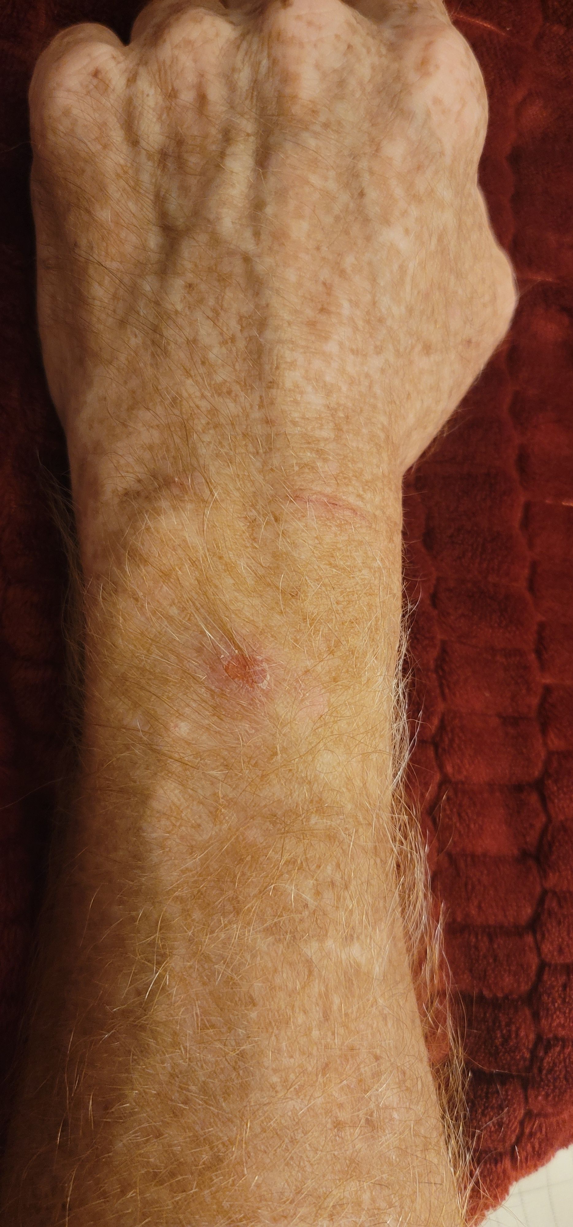 Galaxy Watch 4 hurting my skin - Samsung Community
