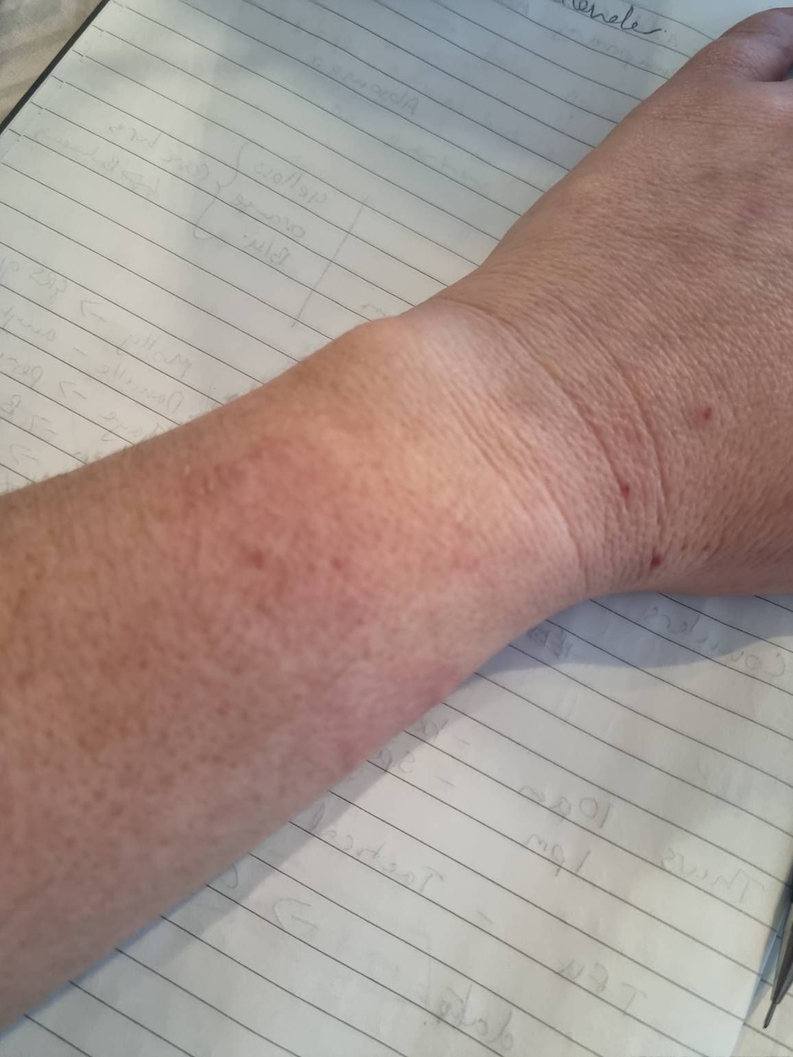 Rash from Galaxy Watch Active - Samsung Community