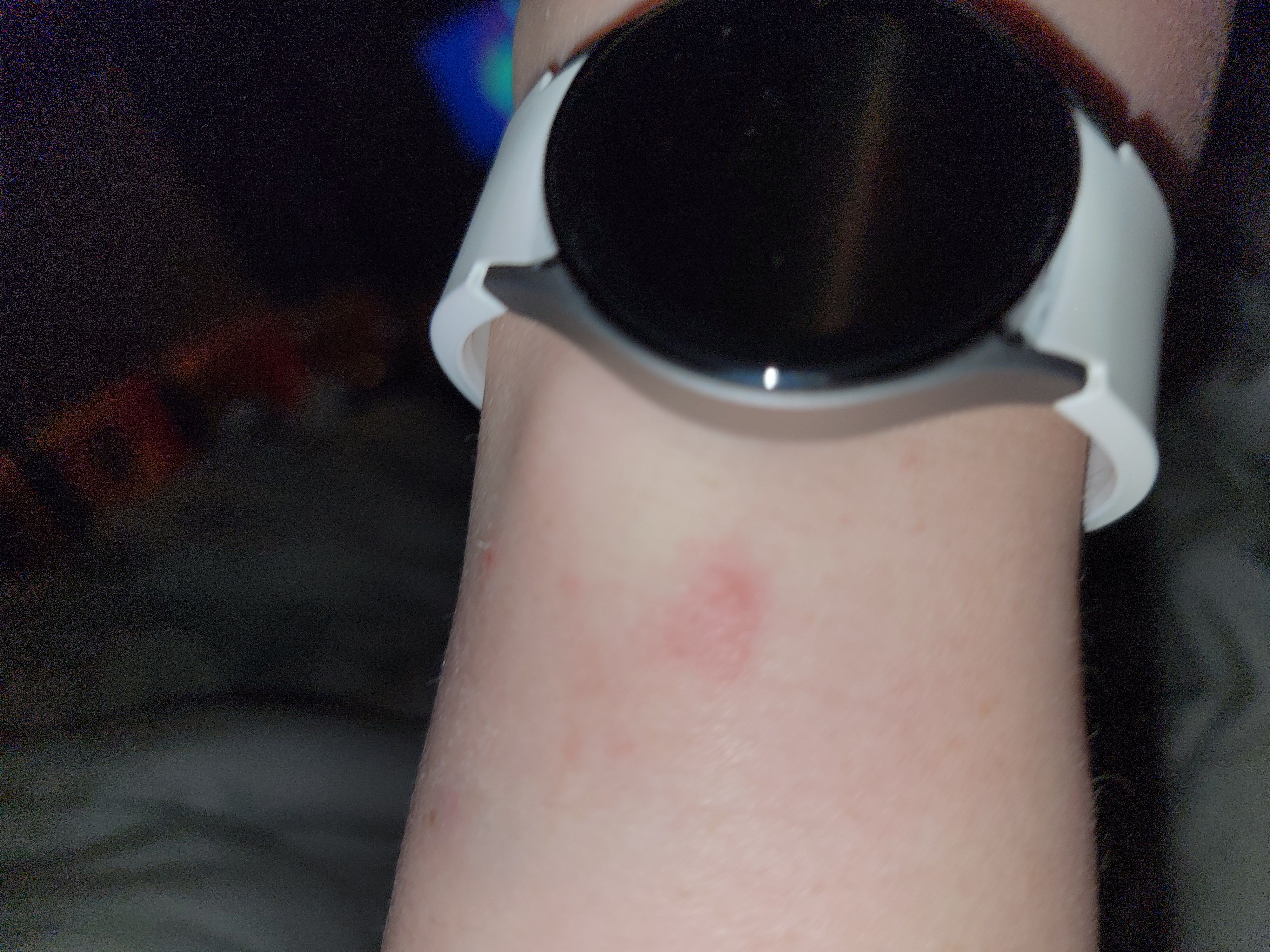 Skin rash/burn from wearing samsung watch - Samsung Community