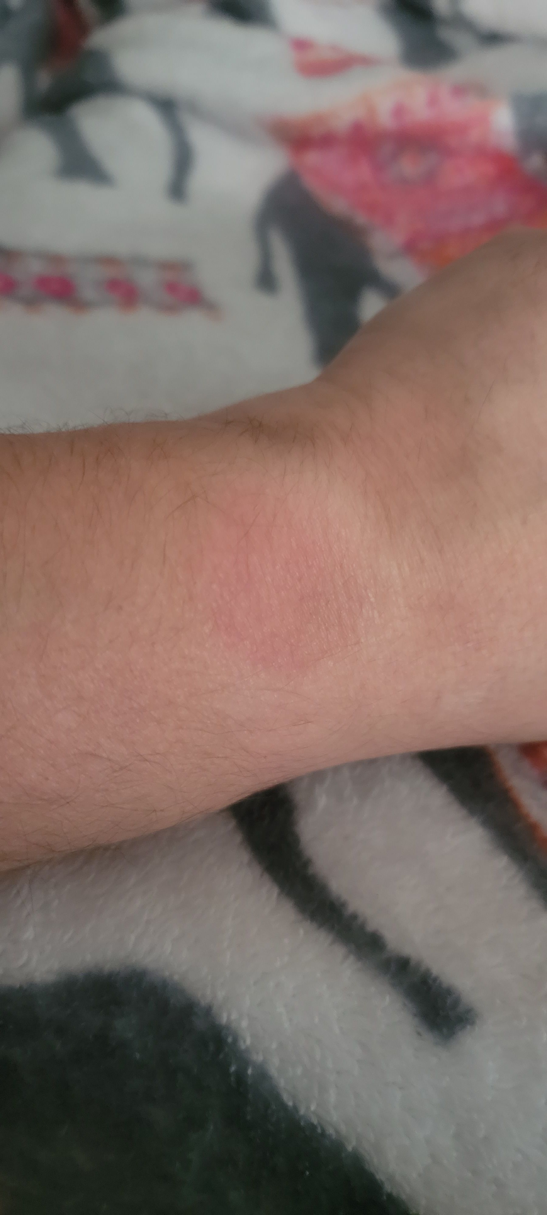Galaxy watch classic wrist burn - Samsung Community
