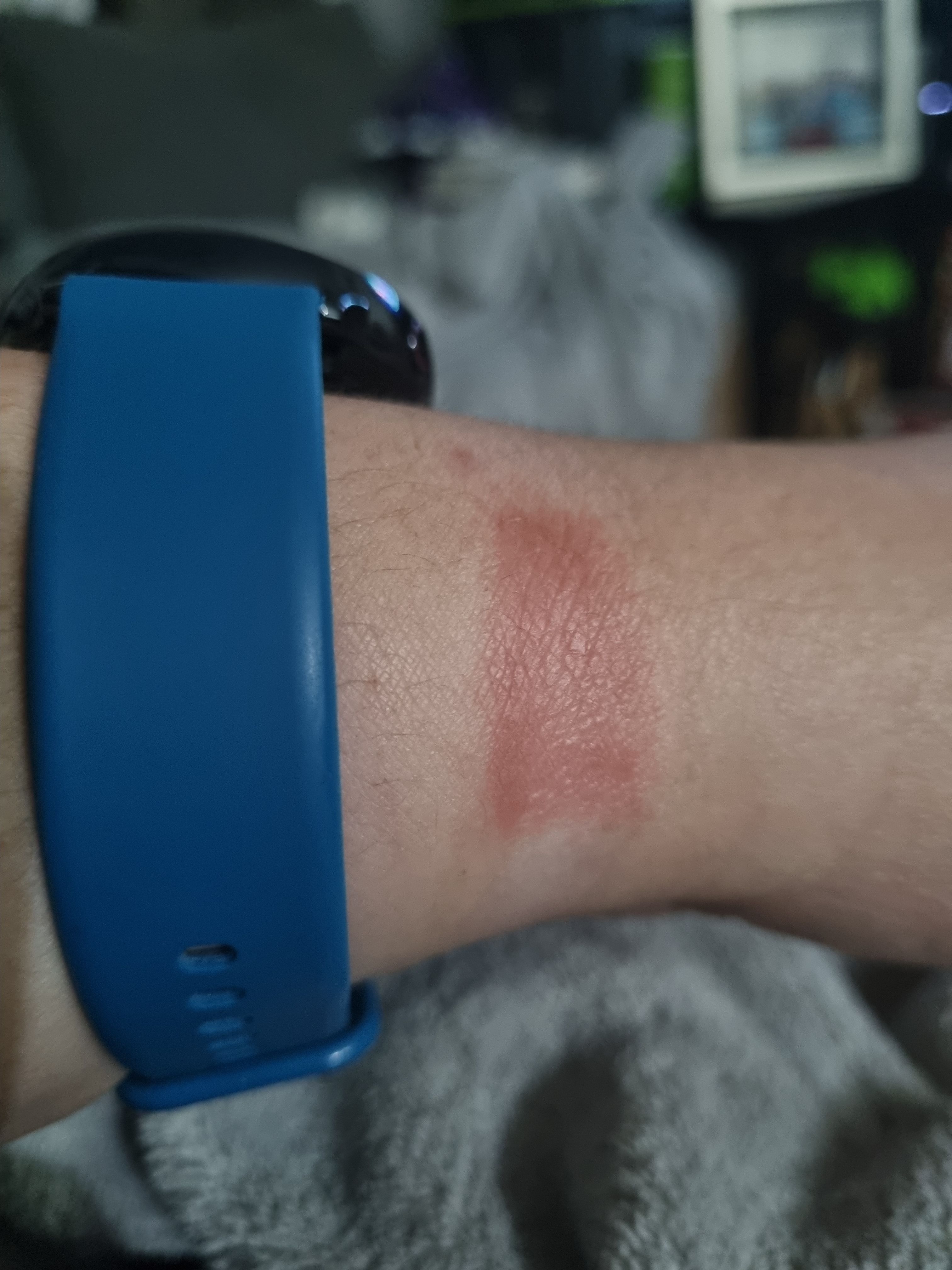 Rash from watch - Samsung Community